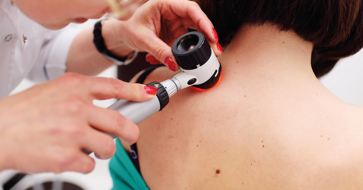 Where to Get Mole Checks for Skin Cancer in North East England | Living ...